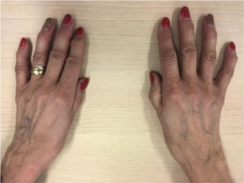 Osteoarthritis – Geelong Hand Therapy