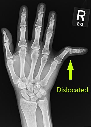 Fractures and Dislocations | Geelong Hand Therapy