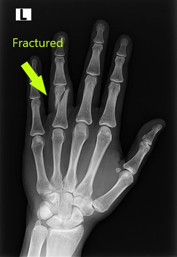 Fractures and Dislocations | Geelong Hand Therapy